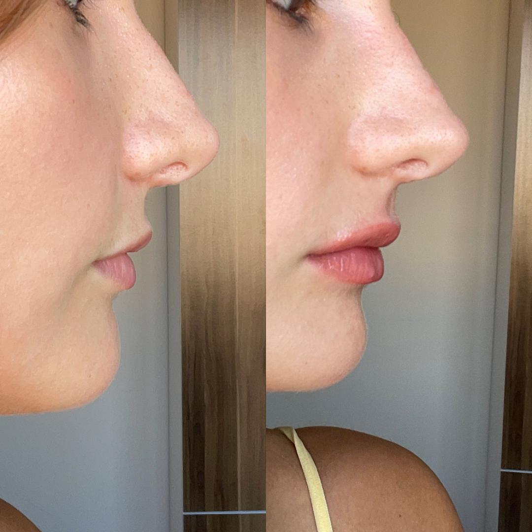 What’s the Secret Behind Plump Lips? Not Needles! – Smooche